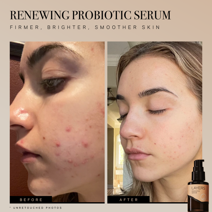 Layers Probiotic Skincare | Best Skin Care Supplements | USA